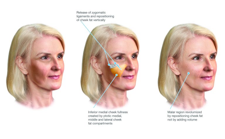 Deep Plane Facelift Surgeon Sydney | Dr Jason Roth FRACS
