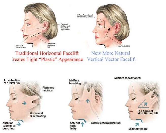 Pre Operative FaceLift Information - Dr Jason Roth | ENT Facial Plastic ...